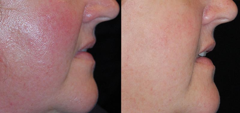 Laser vasculaire, laser rajeunissement, épilation laser à Marseille